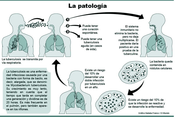 Tuberculosis: infección mundial