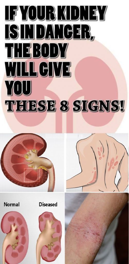 If Your Kidney Is In Danger, The Body Will Give You These 8 Signs ...