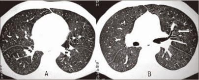 Chest Medicine Made Easy-Dr Deepu: The ‘Dark Bronchus’ Sign: For ...