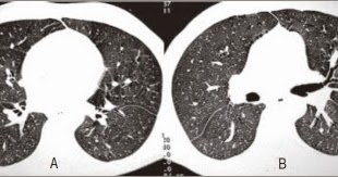 Chest Medicine Made Easy-Dr Deepu: The ‘Dark Bronchus’ Sign: For ...