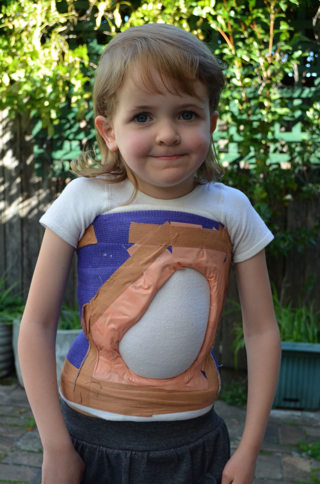 Life with Beals: A new spinal cast - with a 'twist'