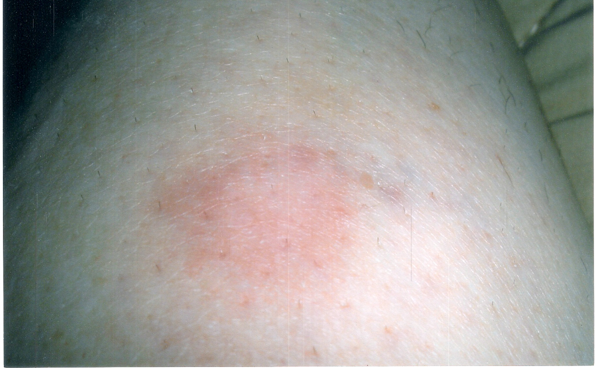 DANGERS OF PEDICLE SCREWS: SPINAL IMPLANT ALLERGIC REACTION OR REJECTION?