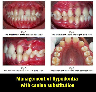 PDF: Management of Hypodontia with canine substitution: A Case Report ...
