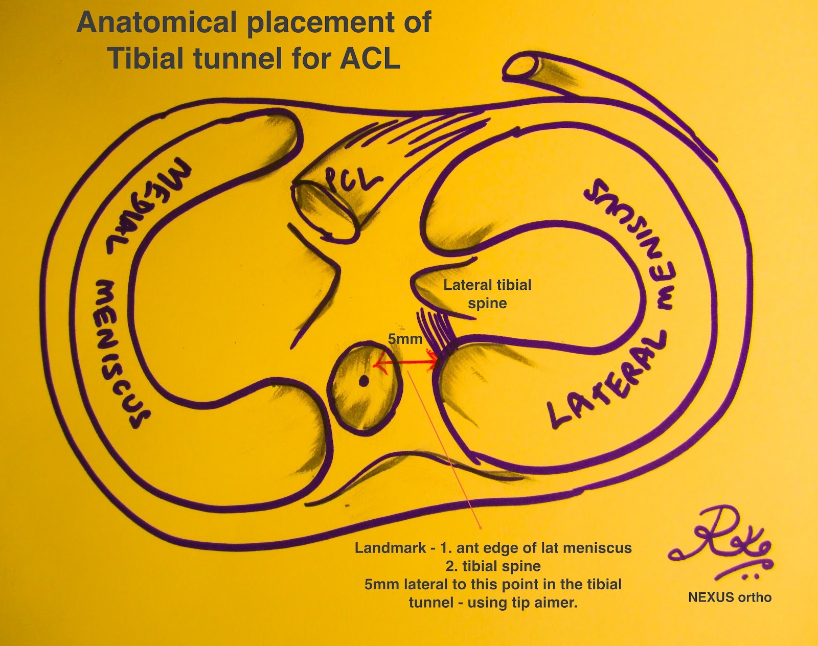Indiaorthosurgeon: Tunnel placement in Anatomical ACL reconstruction