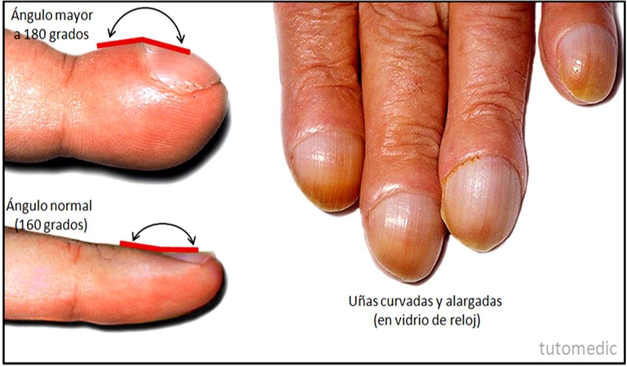 Tutomedic: Imagen de la semana- Acropaquia o hipocratismo digital