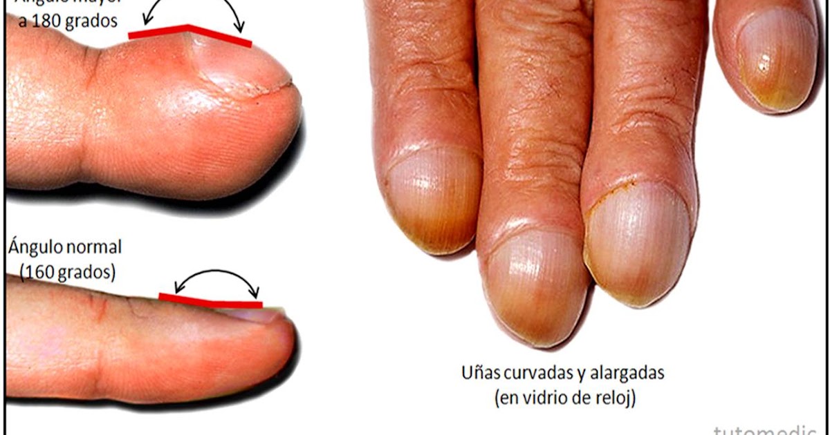 Tutomedic: Imagen de la semana- Acropaquia o hipocratismo digital