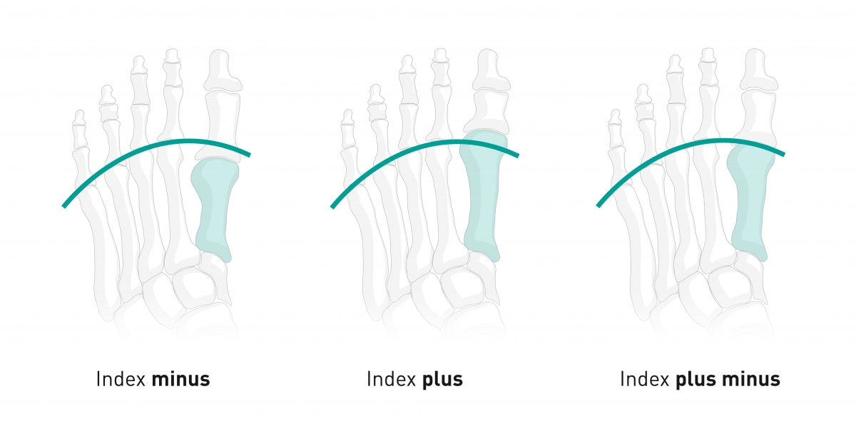 Podología Bethy: Según la longitud del primer metatarsiano