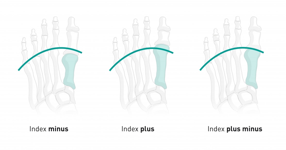 Podología Bethy: Según la longitud del primer metatarsiano