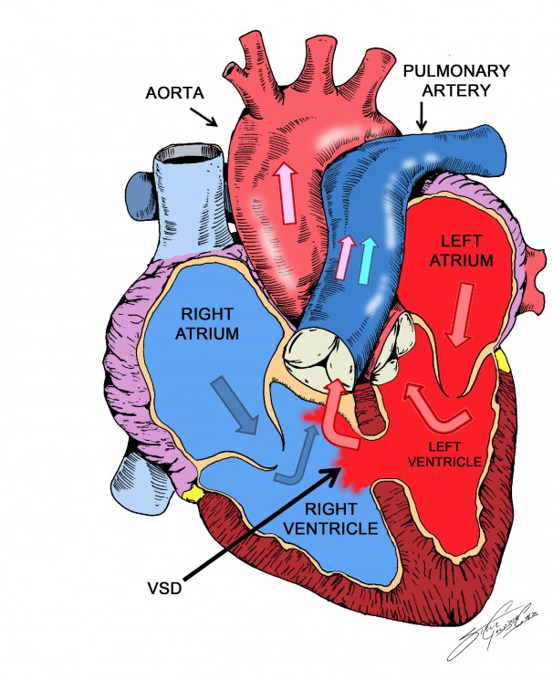Ventricular Septal Defect - Mydokterhewan