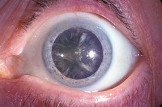 Kenali Tanda-Tanda Kemunculan Mata Katarak Kortikal