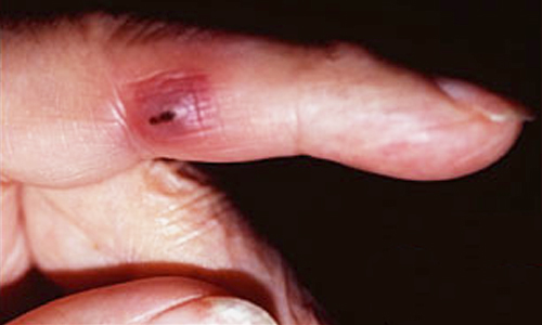 PATOLOGÍA B: ENDOCARDITIS INFECCIOSA