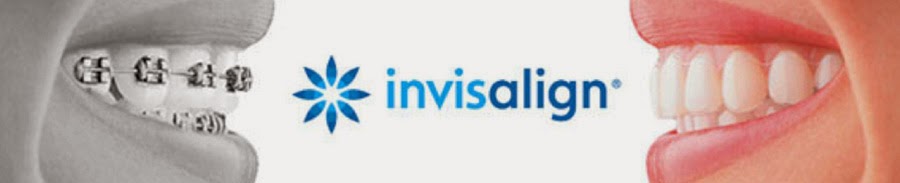 makeupbysaz: Invisalign: 7 weeks into treatment (Tray 1-3 )