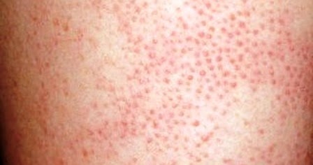 Você sabe o que é e como tratar a Foliculite?