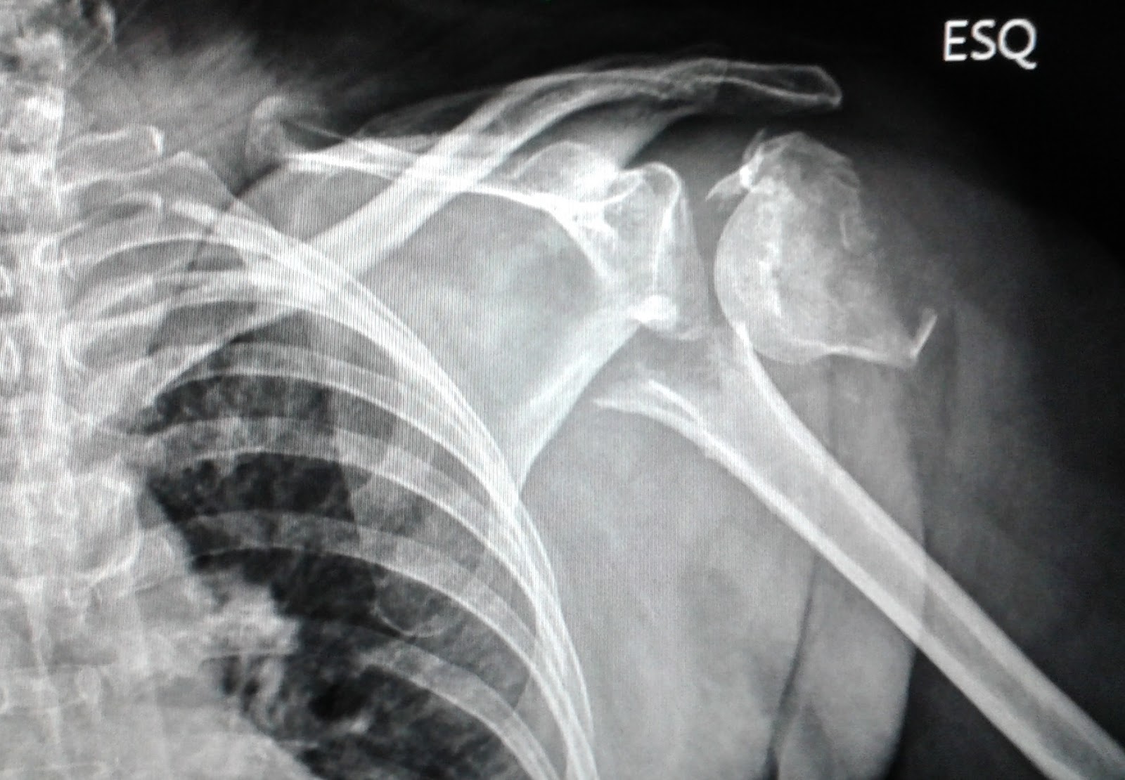 RADIOLOGIA: IMAGENS RADIOLÓGICAS - FRATURA ÚMERO / OMBRO