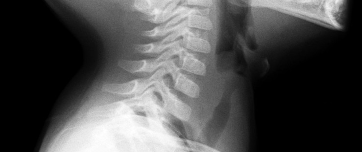 Doenças Raras Doem®: Crupe