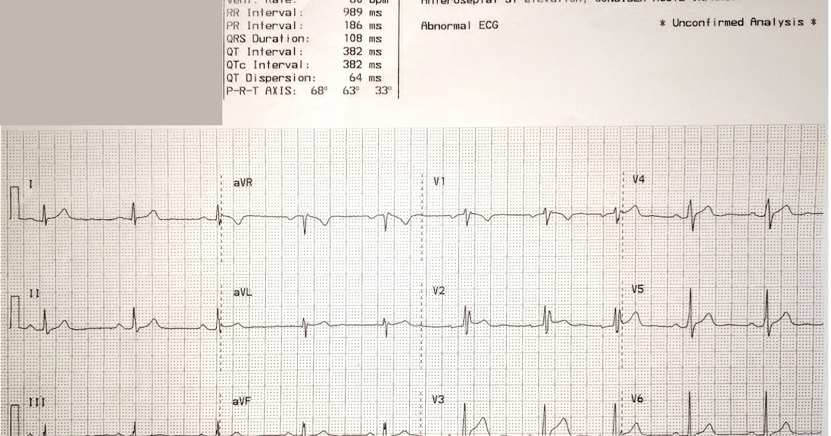 Dr. Smith's ECG Blog: RSR' with ST elevation: is this Right Bundle ...