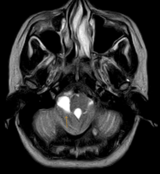 Posterior Fossa Arachnoid Cyst & Tonsillar Descent - Sumer's Radiology Blog