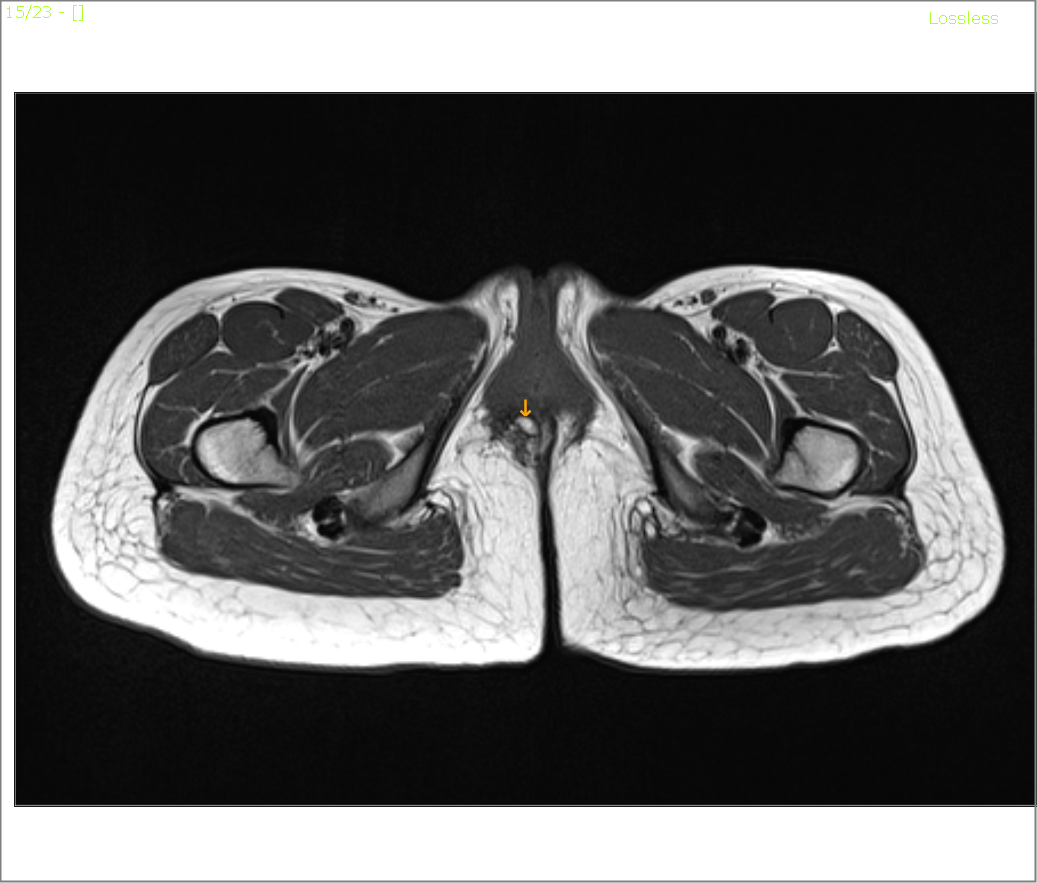 mricases: Episiotomy scar endometriosis