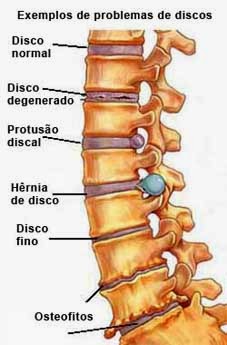 Atividade Física - Prof. Esp. Fábio N. Felix: Cuidados com a coluna ...