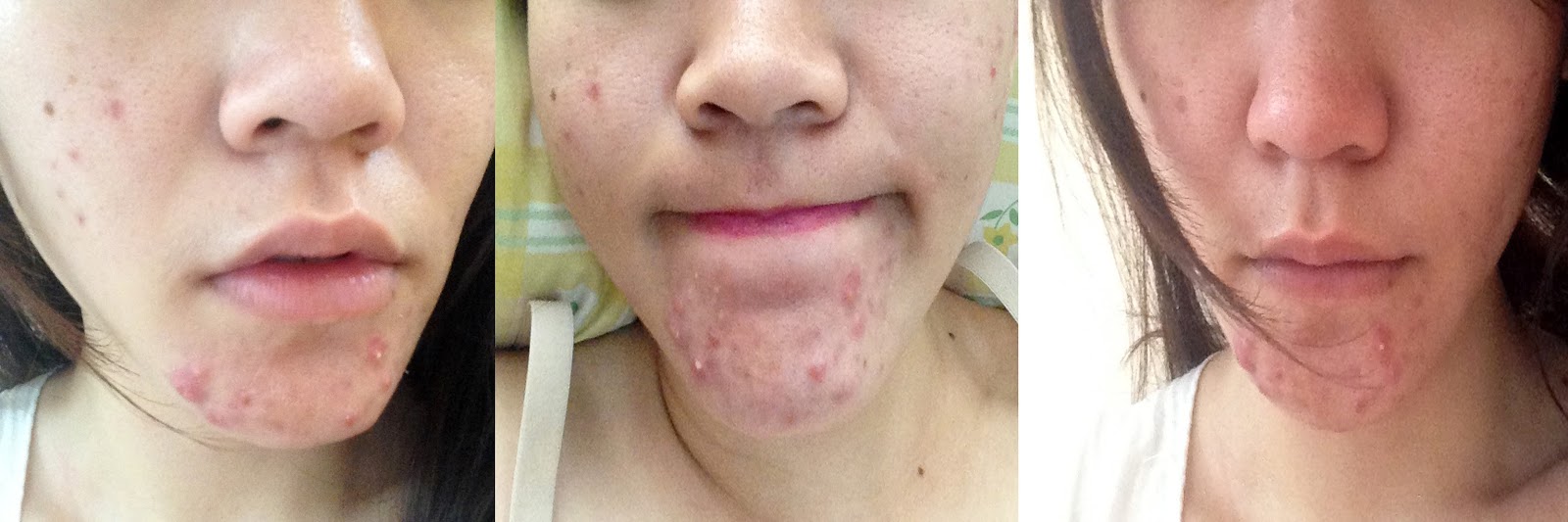 Acne Journey - Dr. Kun Jayanata SpKK(K) Review - Colored Canvas