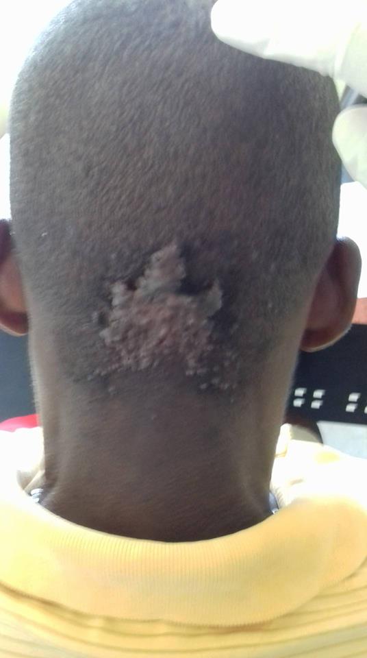 Acné Keloidalis Nuchae Antes Y Después