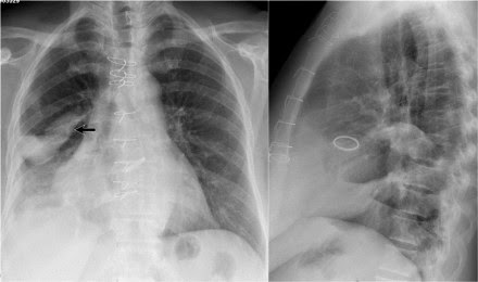 Chest Medicine Made Easy-Dr Deepu: Basics Of Chest X Ray Part-6, The ...