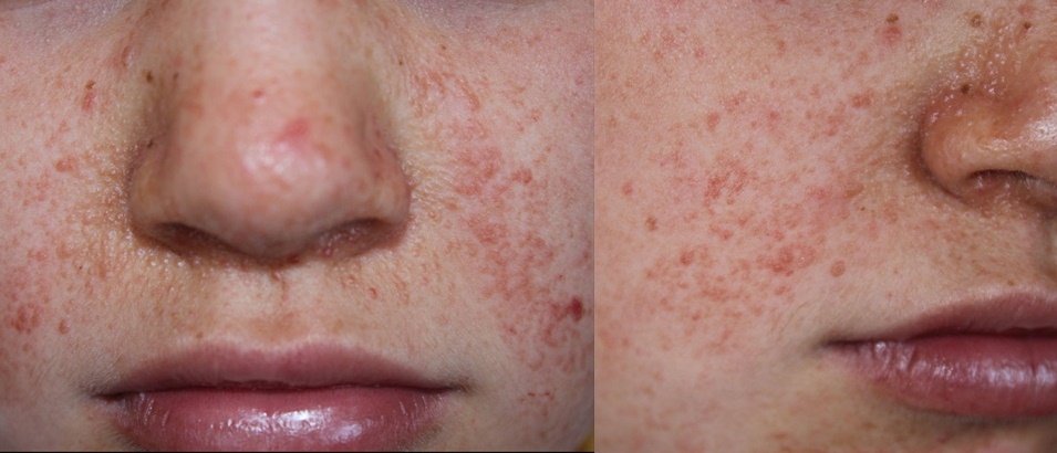 MEDIKA KEPERAWATAN: Maret 2018