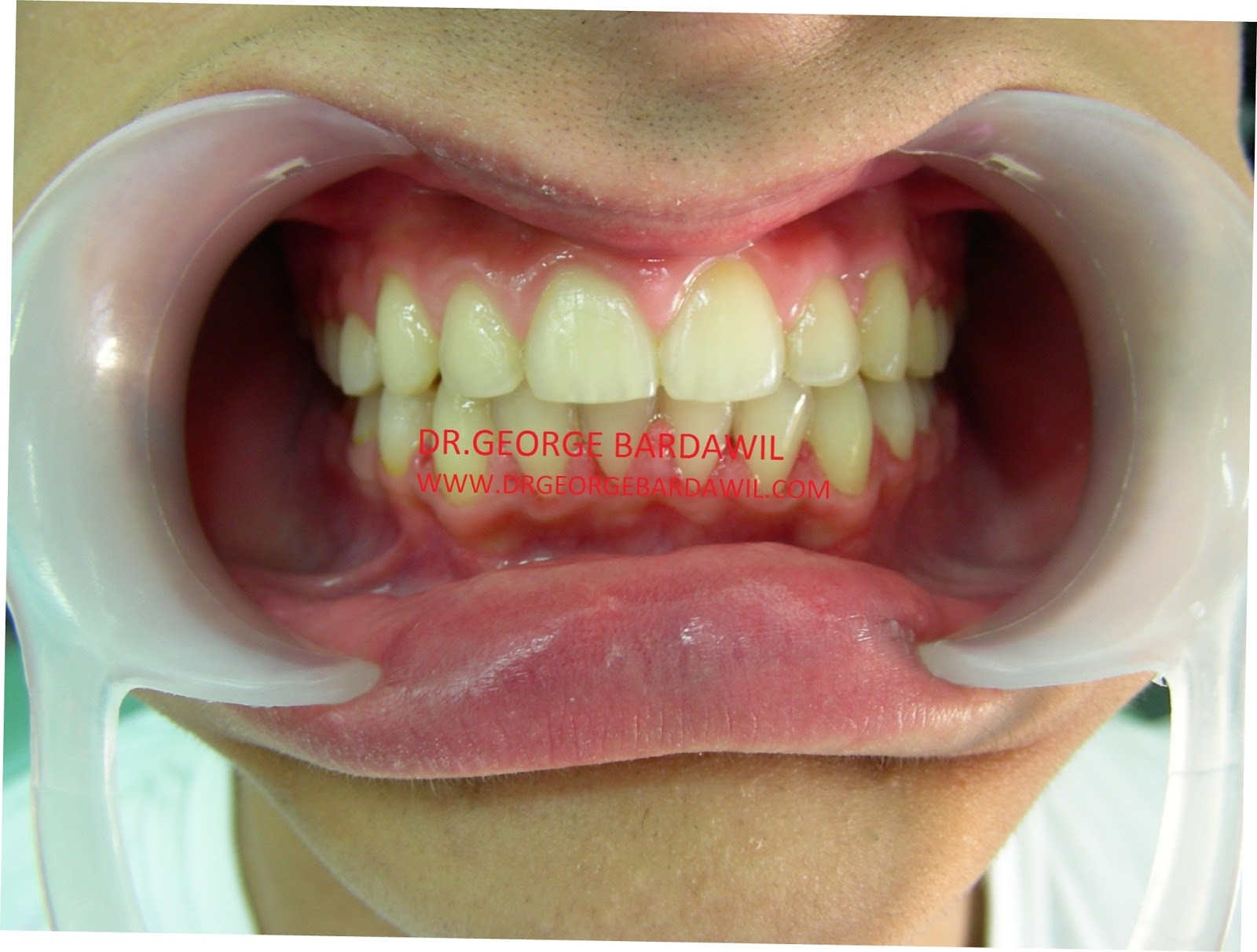 Dr.George E. Bardawil-Orthodontist-Invisalign Diamond level : Why Teeth ...