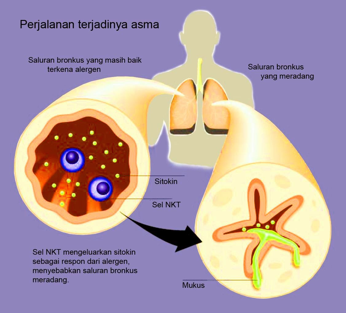 PENYAKIT ASMA & TIPS PENGOBATANNYA - Tips Kesehatan dan Kecantikan