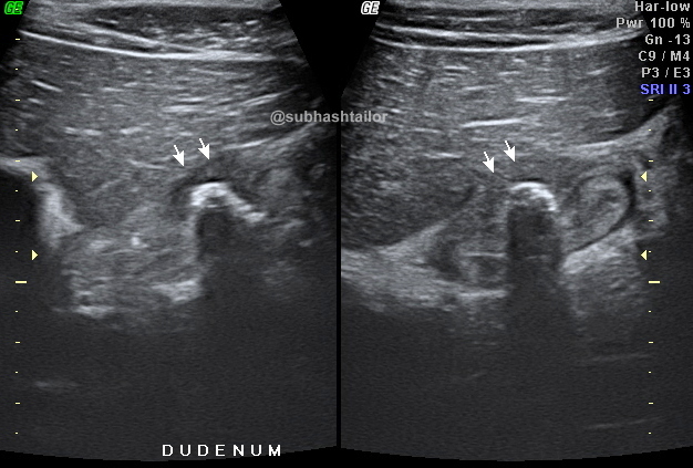 SONO DIGEST: DUODENAL USG