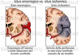 NeuroPsico Blog: ICTUS CEREBRALE