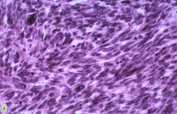 Leiomiosarcoma: leiomiosarcoma
