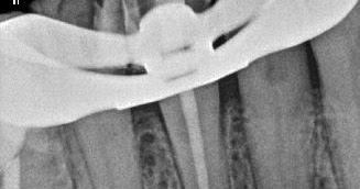 Proendodoncia.blogspot.com: puffs apicales: éxito o fracaso endodóntico