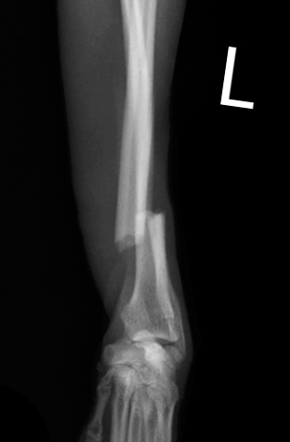 ARTROVET: Férula en fractura de Cúbito y Radio