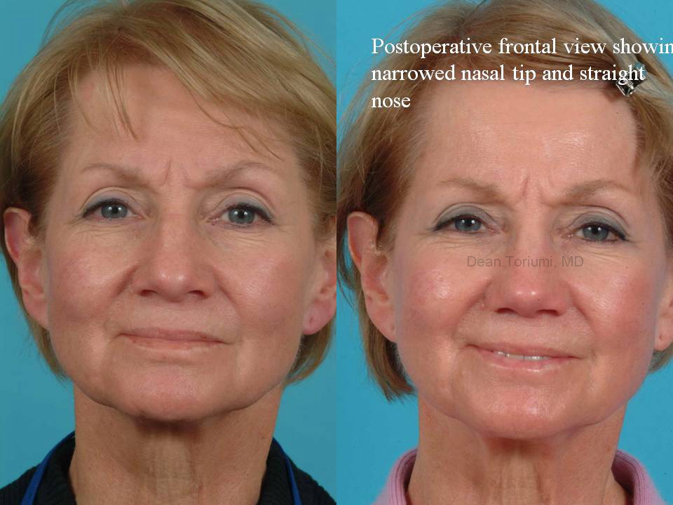 Dr. Dean Toriumi Reviews: Dean Toriumi Reviews: Patient presented with ...