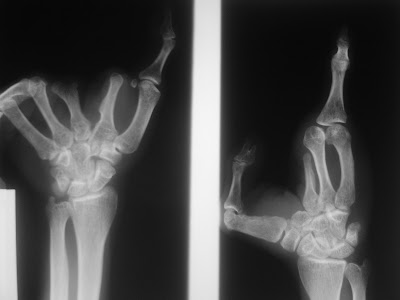 GEDR: Ectrodactyly Síndrome EEC