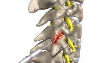 Overview of the cervical or thoracic medial branch block, Southlake ...