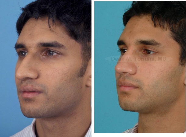 Dr. Dean Toriumi Reviews: Dean Toriumi Nasal Surgery