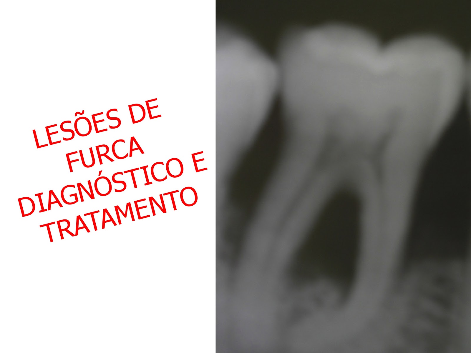 Lesão De Furca Sintomas - BRAINCP