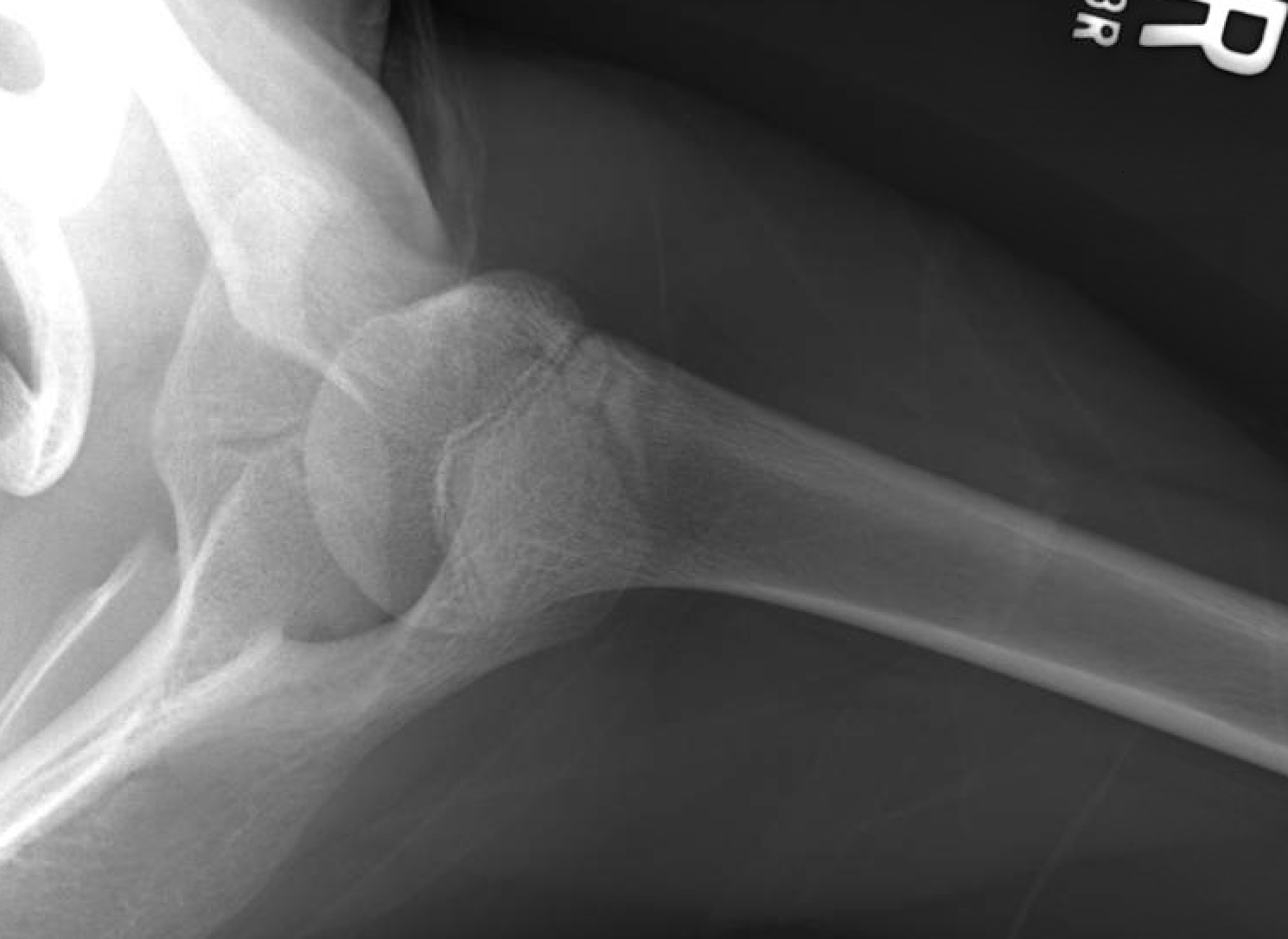 Shoulder and Elbow Surgery: Posterior chondrolabral cleft and recurrent ...