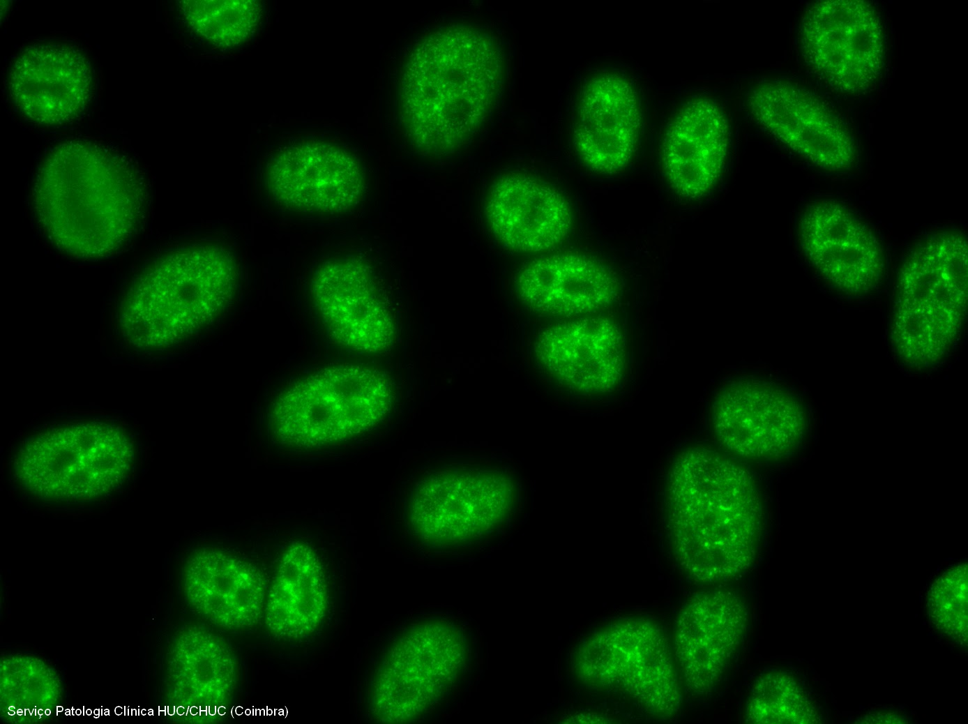 Anticorpos anti - Sm e anti - RNP