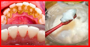 Que es el sarro dental - Consecuencias y porque se produce