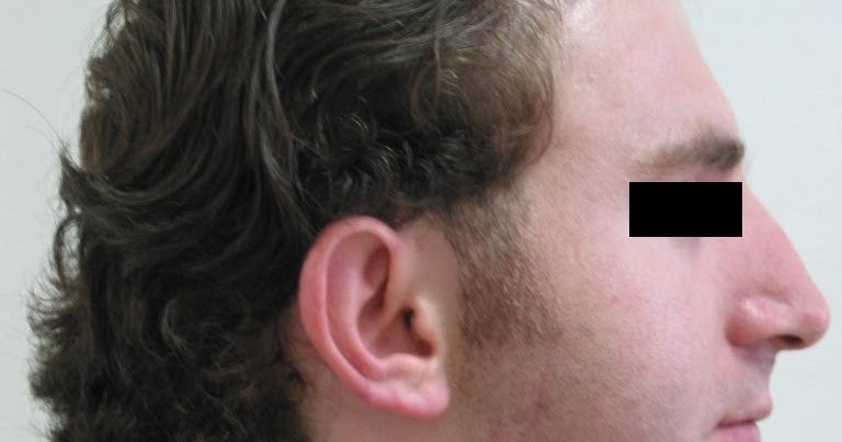 Retrognathia - Pictures, Symptoms, Causes, Treatment - Health Care Tips ...