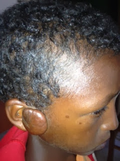Engage Now Africa: Ethiopia: Keloid Removal Surgery Success Story