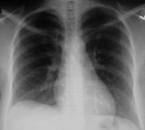 COCHIN CARDIAC CLUB: INTERNAL BLEEDING