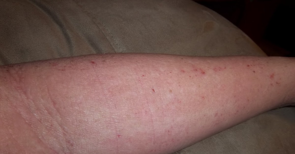 Stopping Topical Steroids : My first AWESOME skin day since starting TSW!!