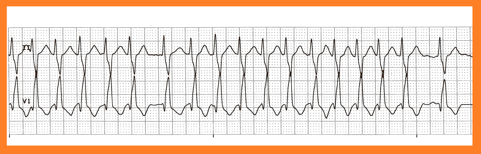 Practice EKG Strips 320