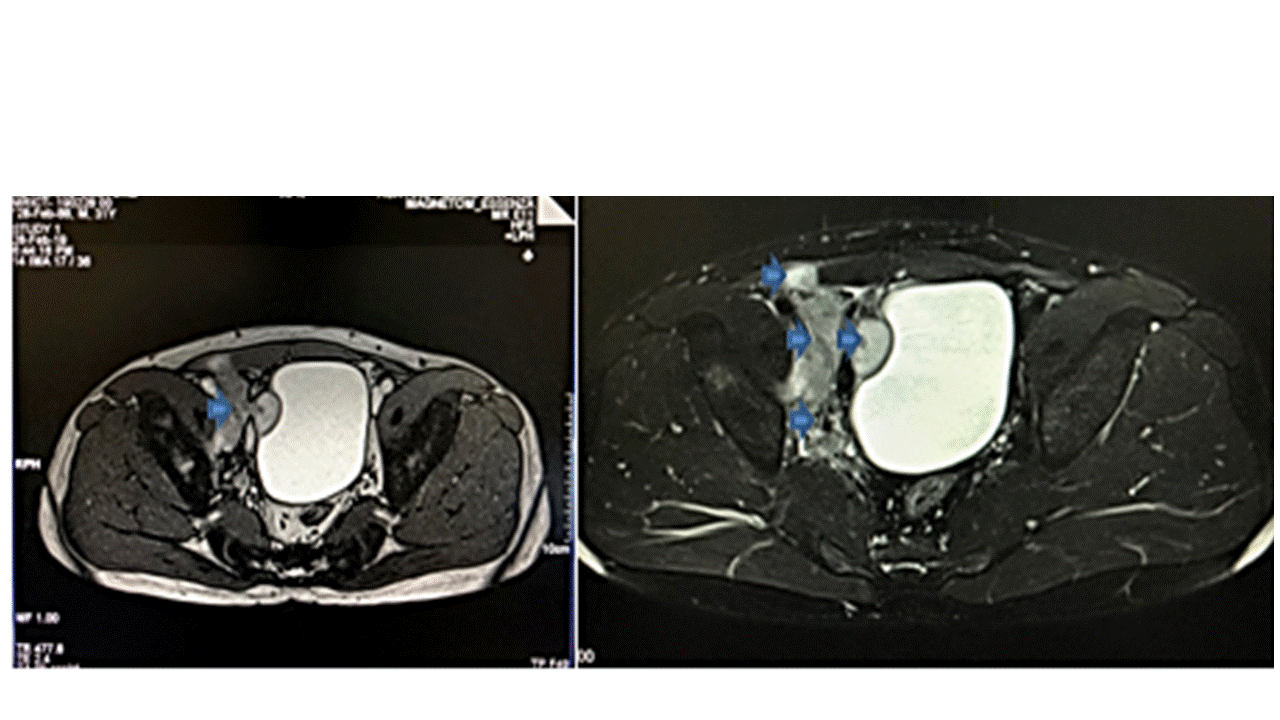 VIETNAMESE MEDIC ULTRASOUND: CASE 543: PELVIC WALL ABSCESS, Dr PHAN ...