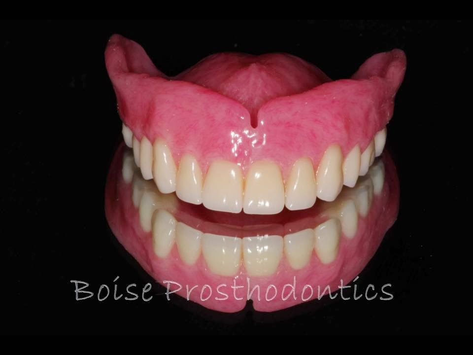 Boise Idaho Prosthodontics: Maxillary Complete Denture / Mandibular 5 ...