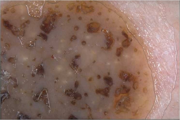 Dermatoscopia: Milia-like cysts